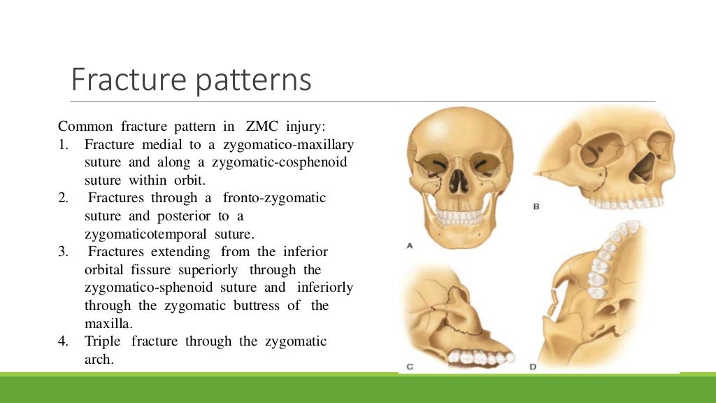 ZMC Fracture