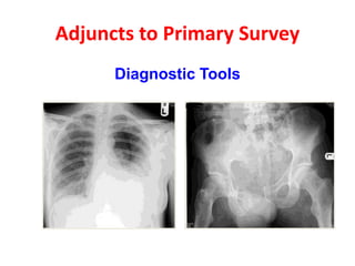 Primary survey in Trauma | PPTX