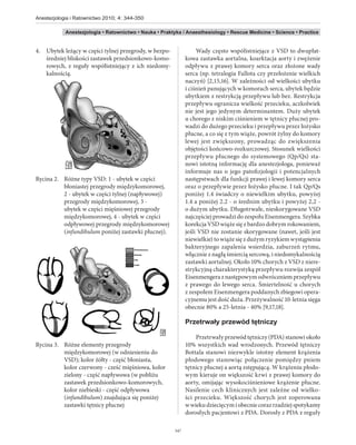 Znieczulenie doroslego pacjenta z wada serca | PDF