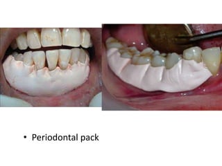 ZOE -ZINC OXIDE EUGENOL | PPTX