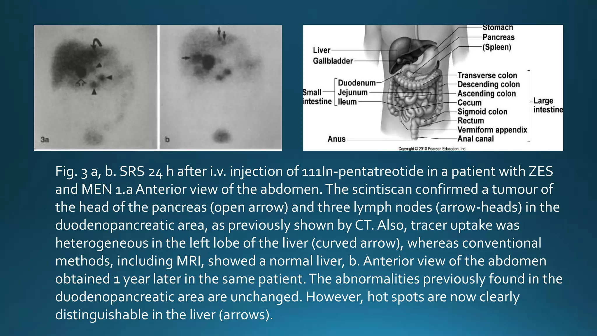 ZOLLINGER-ELLISON-SYNDROME_GARCIA_JENNIFER.pdf