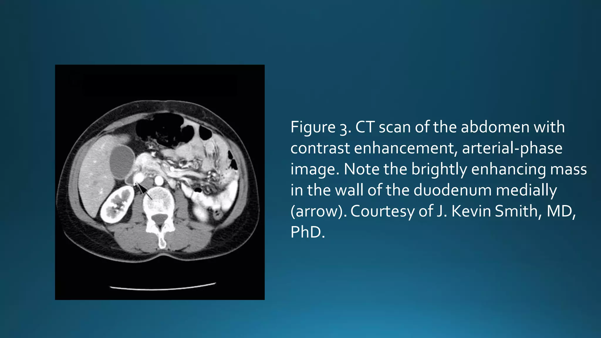 ZOLLINGER-ELLISON-SYNDROME_GARCIA_JENNIFER.pdf