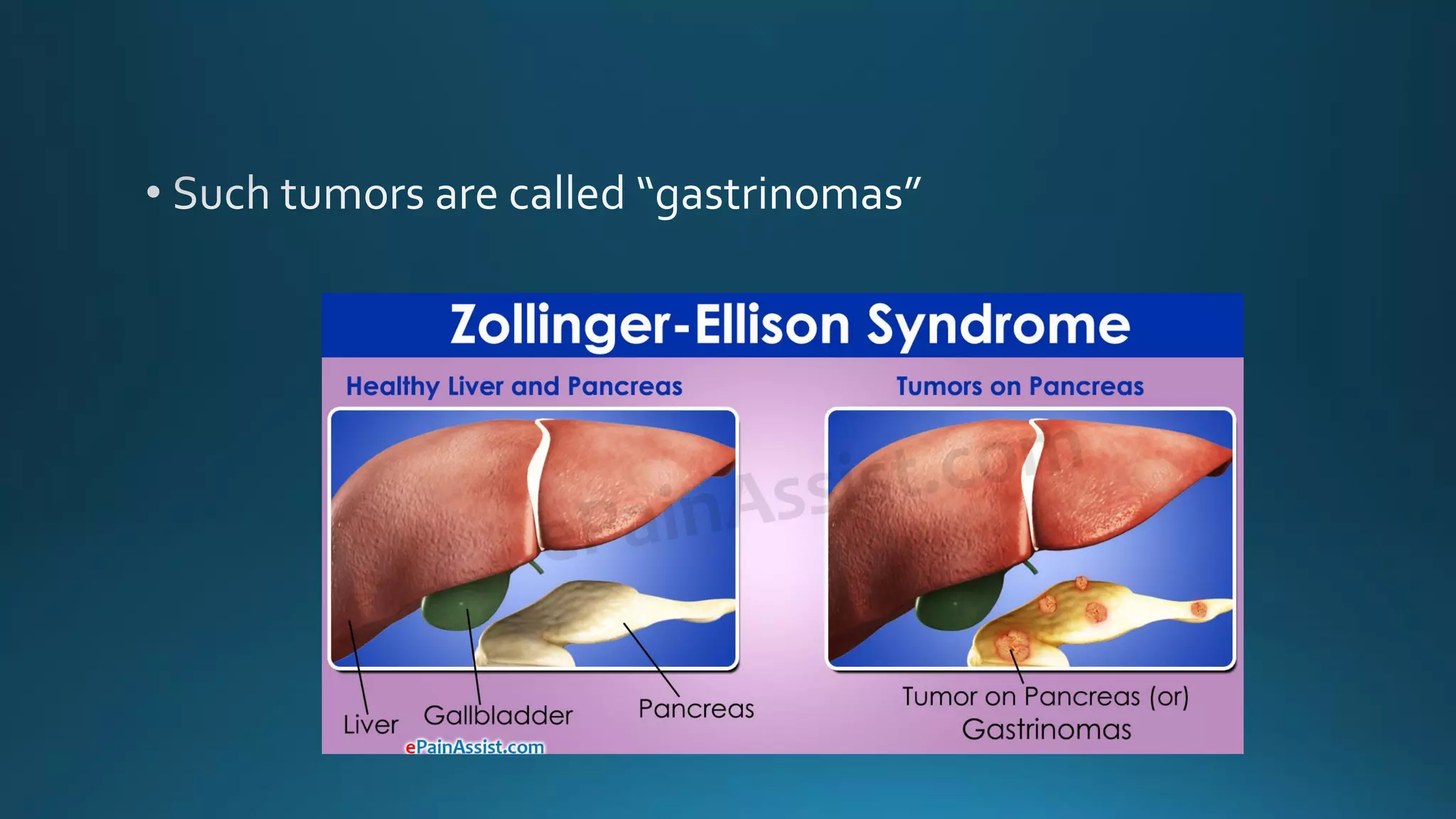 ZOLLINGER-ELLISON-SYNDROME_GARCIA_JENNIFER.pdf