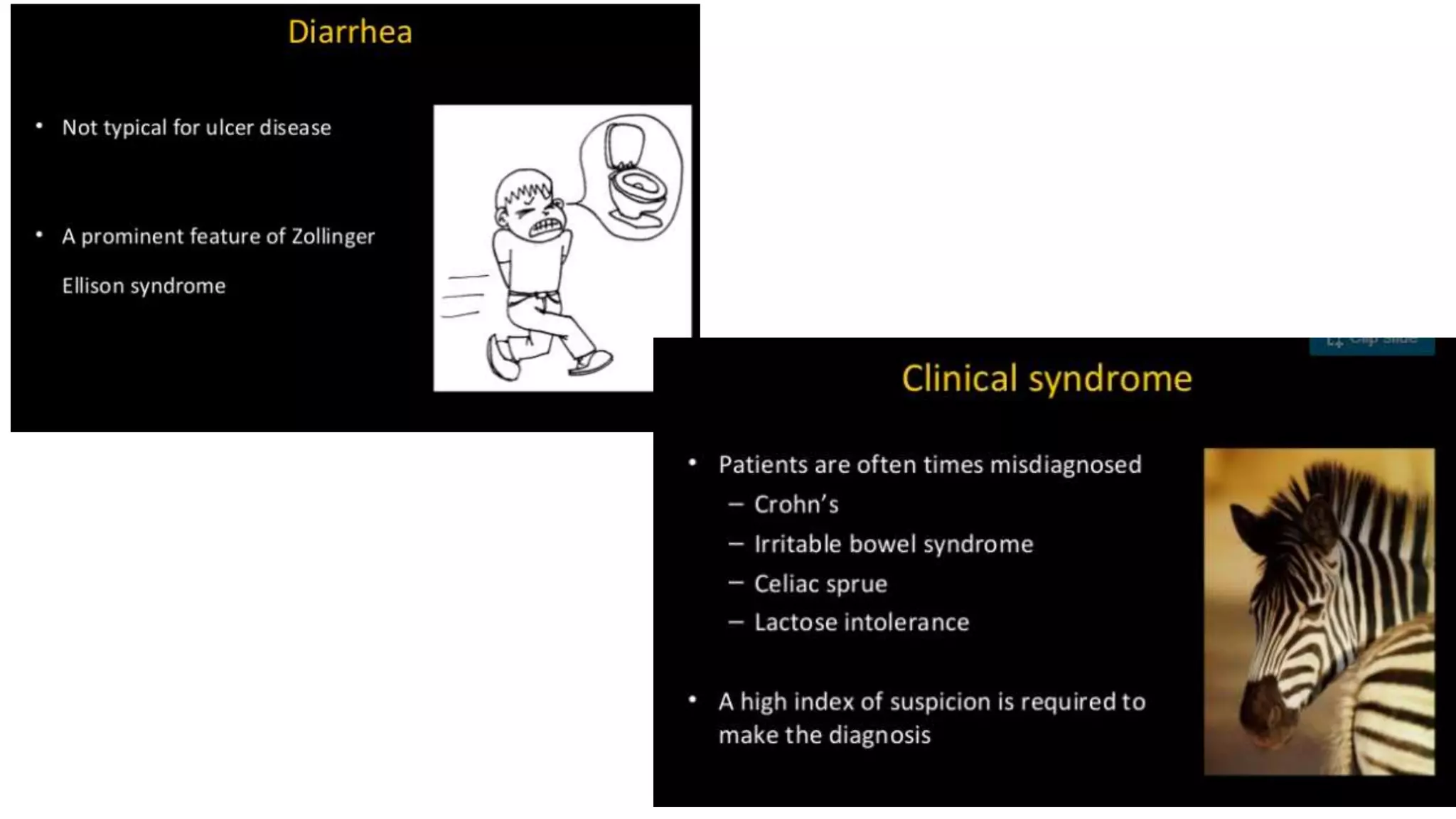 Zollinger ellison syndrome | PPTX