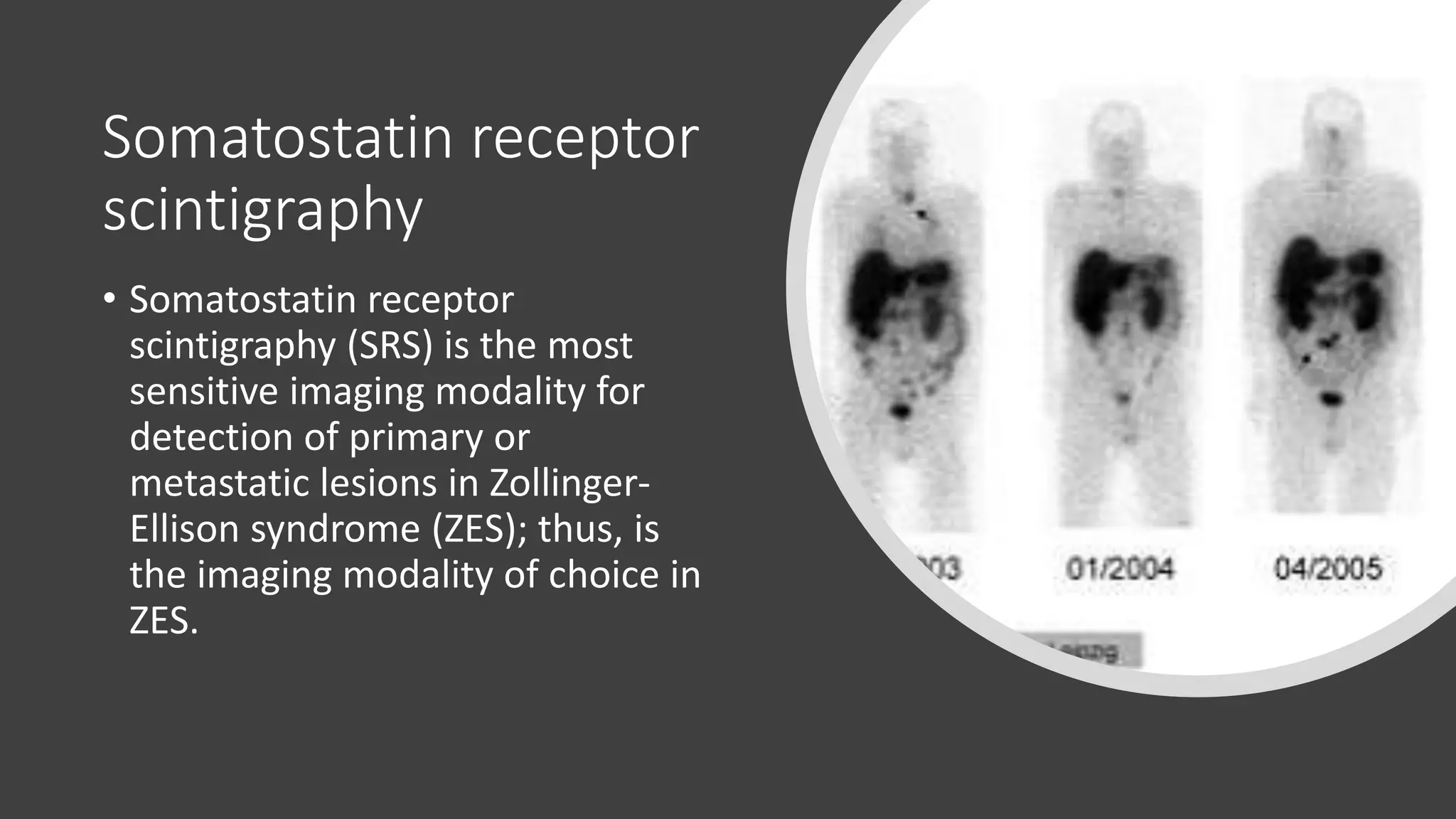 Zollinger ellison syndrome | PPTX