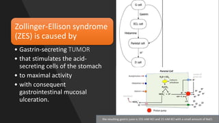 Zollinger ellison syndrome | PPTX