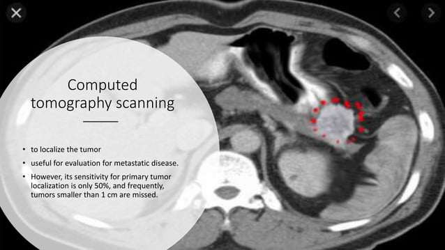 Zollinger ellison syndrome | PPTX | Endocrine and Metabolic Diseases ...