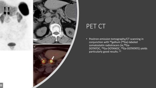 Zollinger ellison syndrome | PPTX | Endocrine and Metabolic Diseases ...