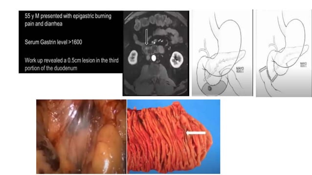 Zollinger ellison syndrome | PPTX | Endocrine and Metabolic Diseases ...