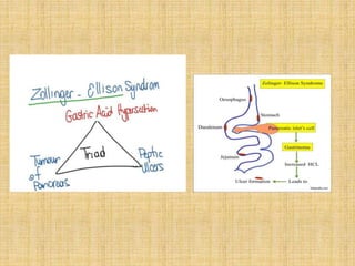 Zollinger ellison seminar | PPTX