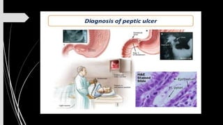 Zollinger – ellison syndrome | PPTX