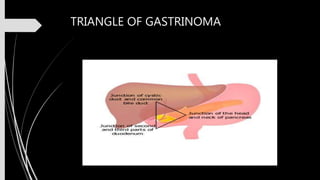 Gastrinoma Triangle