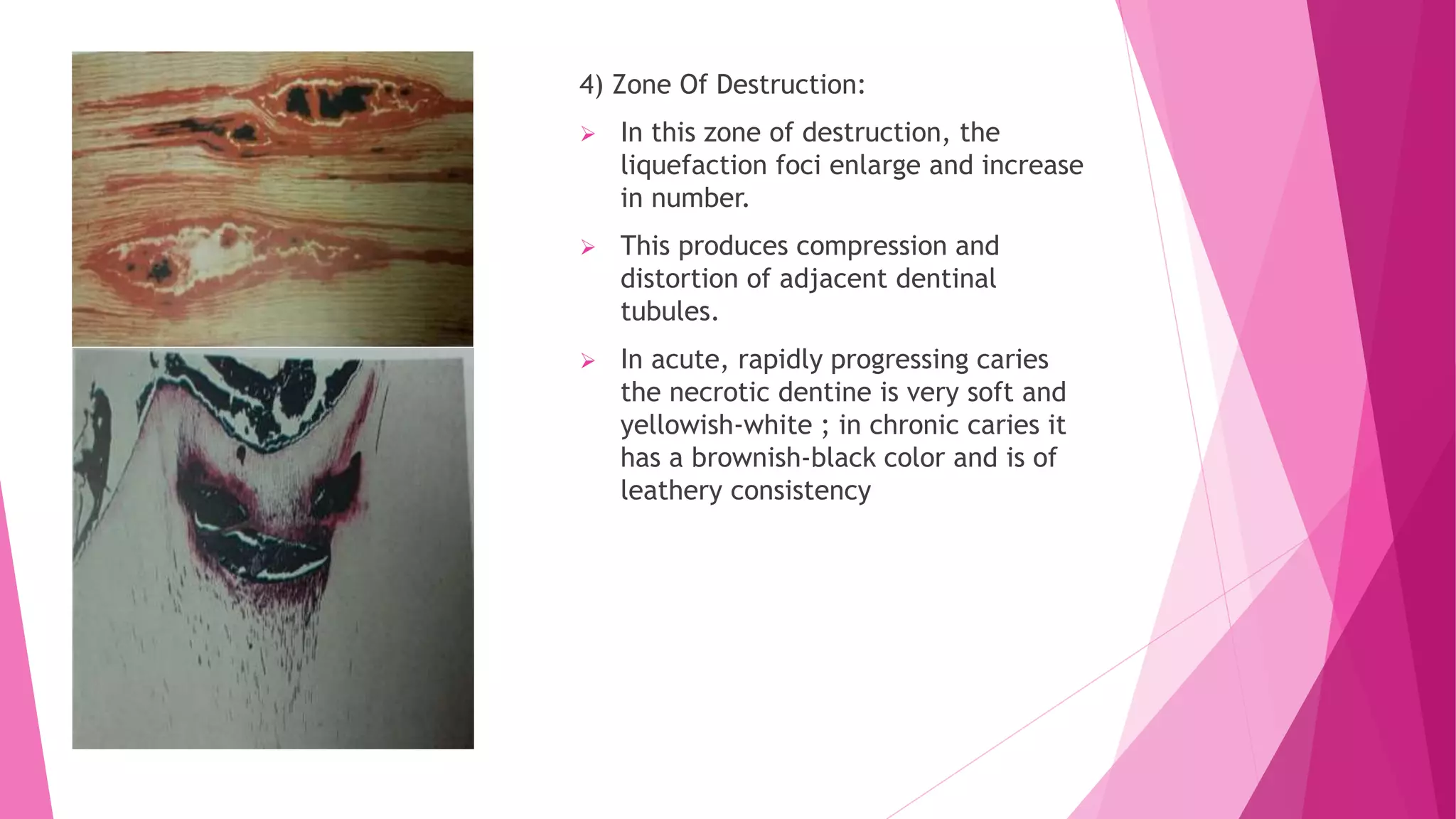 Zones of enamel and dentinal caries completed | PPTX