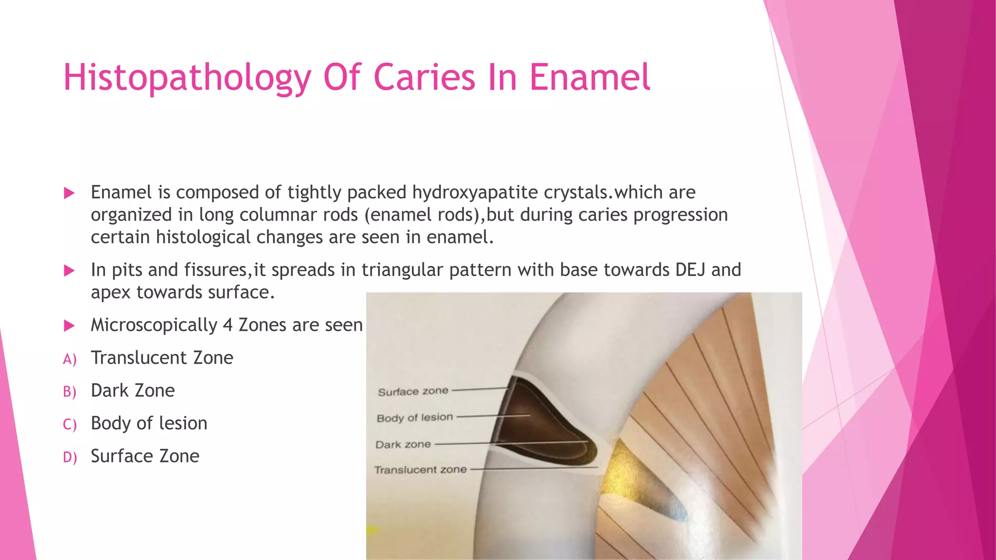 Zones of enamel and dentinal caries completed | PPTX