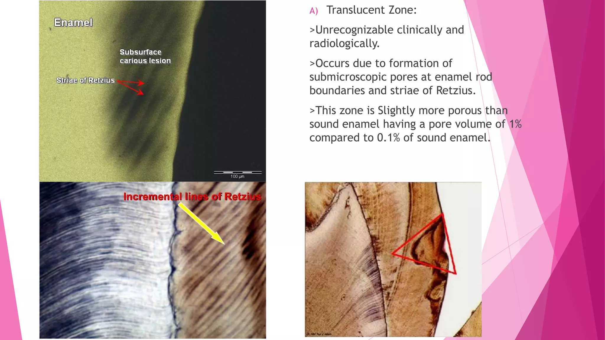 Zones of enamel and dentinal caries completed | PPTX