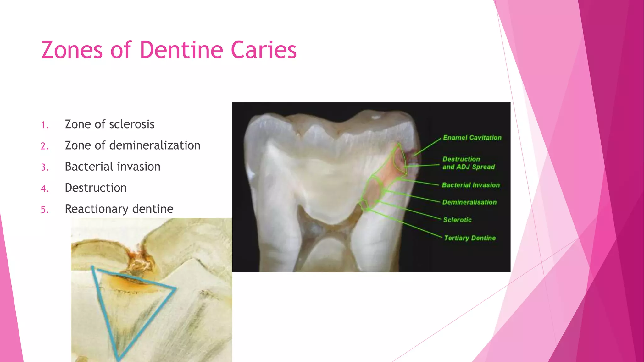 Zones of enamel and dentinal caries completed | PPTX