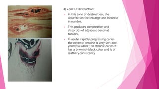 Zones of enamel and dentinal caries completed | PPTX