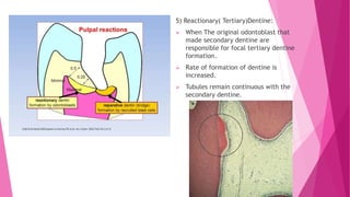 Zones of enamel and dentinal caries completed | PPTX