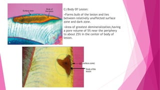 Zones of enamel and dentinal caries completed | PPTX