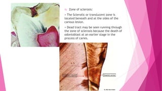 Zones of enamel and dentinal caries completed | PPTX