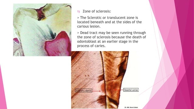 Zones of enamel and dentinal caries completed | PPTX | Dental Health ...