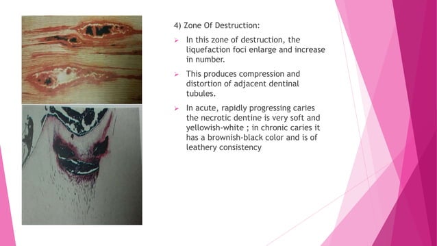 Zones of enamel and dentinal caries completed