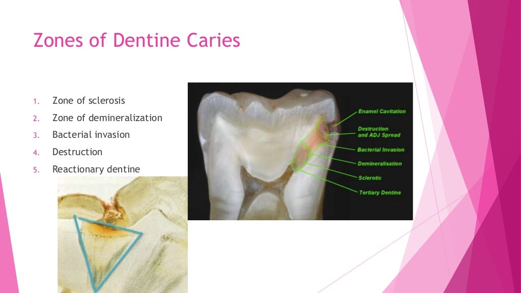 Zones Of Enamel And Dentinal Caries Completed