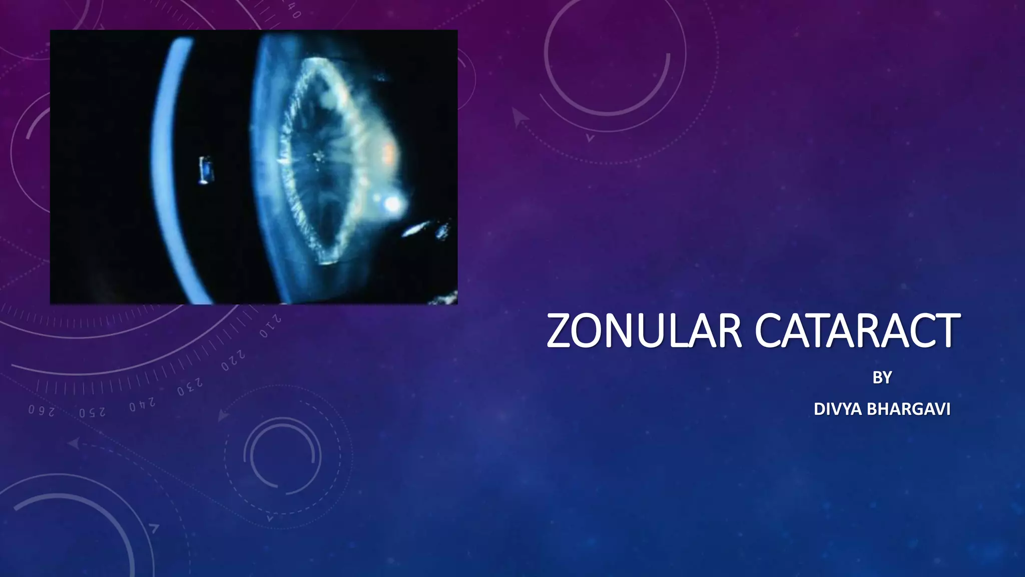 Zonular cataract | PPTX