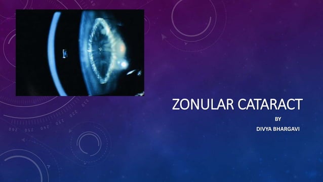 Zonular cataract | PPTX