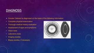 Zonular cataract | PPTX