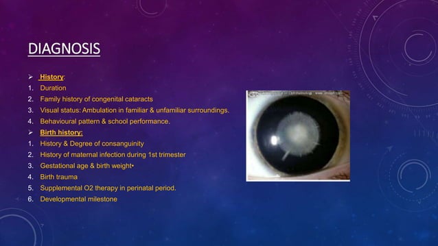Zonular cataract | PPTX