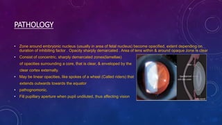 Zonular cataract | PPTX