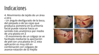 Z plastia Modulo de cirugia genral Medicina | PPTX