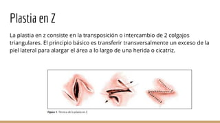Z plastia Modulo de cirugia genral Medicina | PPTX