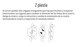 Z plastia Modulo de cirugia genral Medicina | PPTX