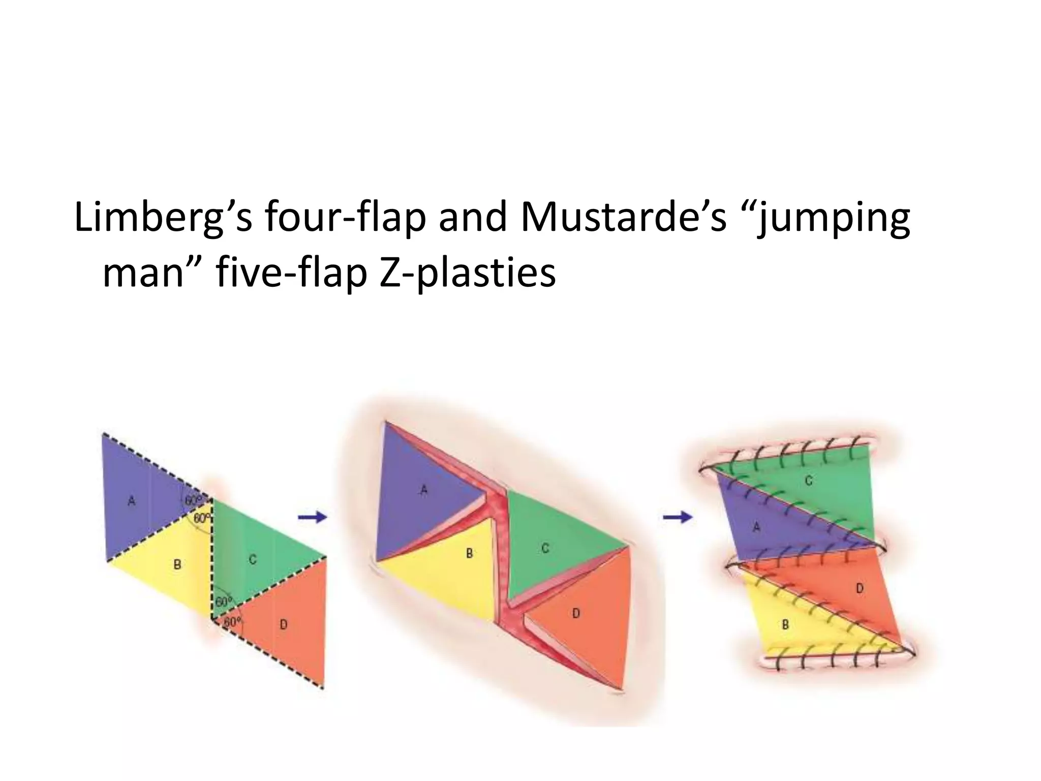 Z plasty in scar contracture release | PPTX