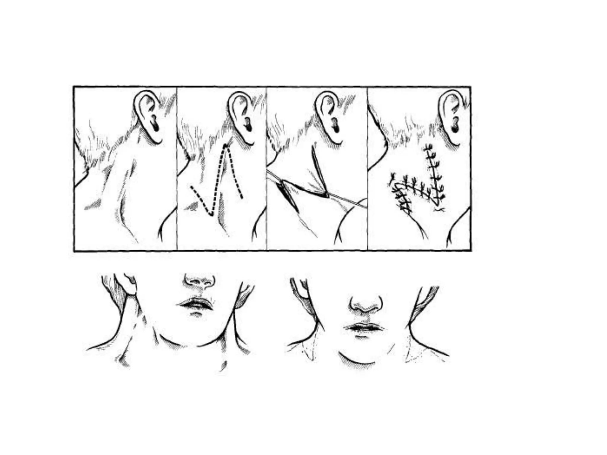 Z plasty in scar contracture release | PPTX