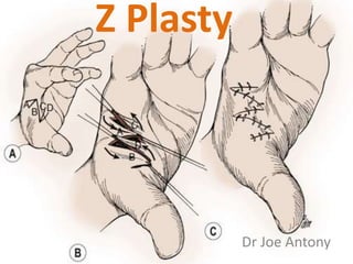 Z plasty in scar contracture release | PPTX