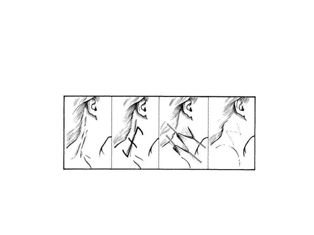 Z plasty in scar contracture release | PPTX | Death, Injury, or ...