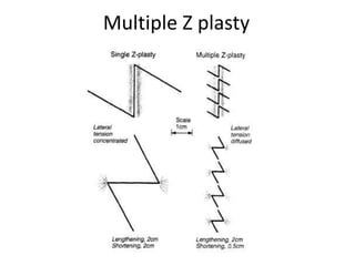 Z plasty in scar contracture release | PPTX
