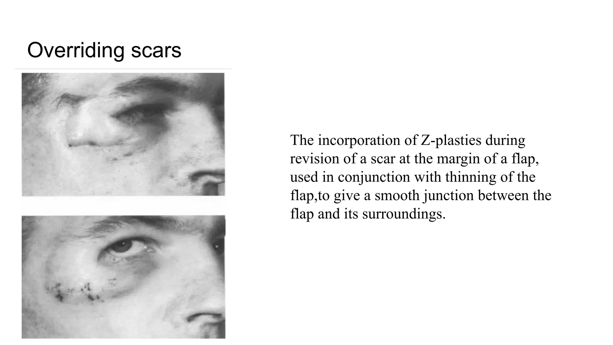 Z plasty and its variations SA. - usefulness applications | PPTX