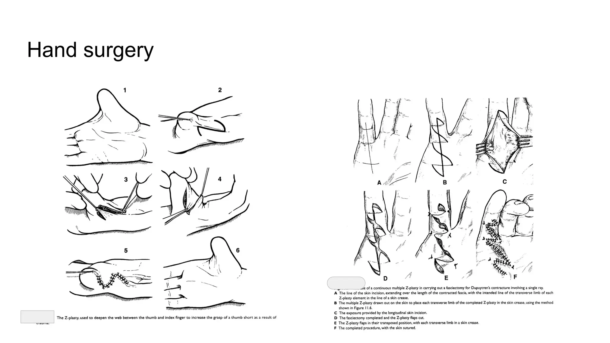 Z plasty and its variations SA. - usefulness applications | PPTX