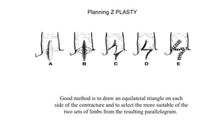 Z plasty and its variations SA. - usefulness applications | PPT