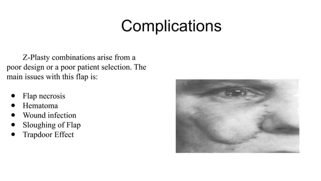 Z plasty and its variations SA. - usefulness applications | PPT