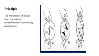 Z plasty and its variations SA. - usefulness applications | PPTX