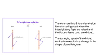 Z plasty and its variations SA. - usefulness applications | PPTX