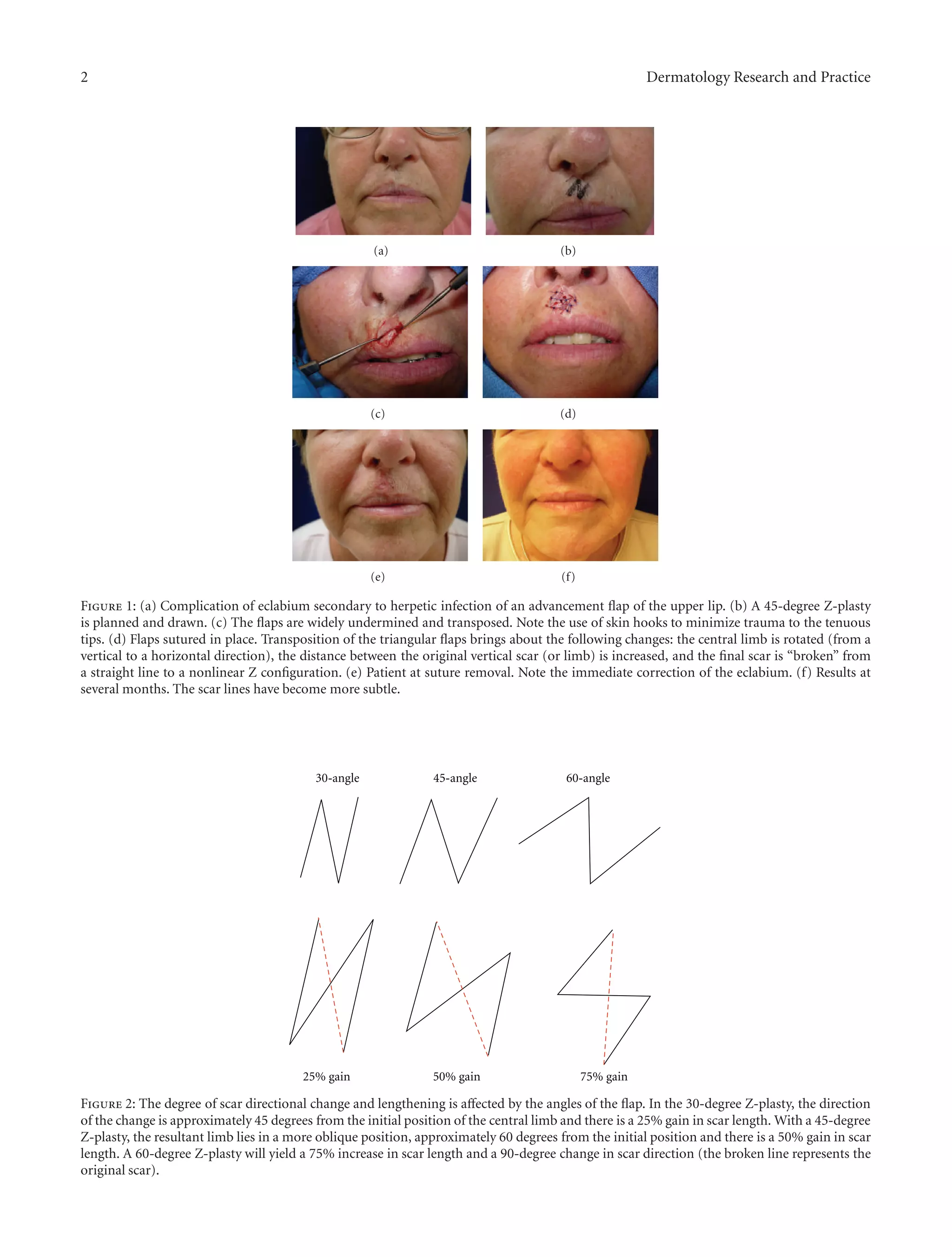 Z plasty made simple | PDF