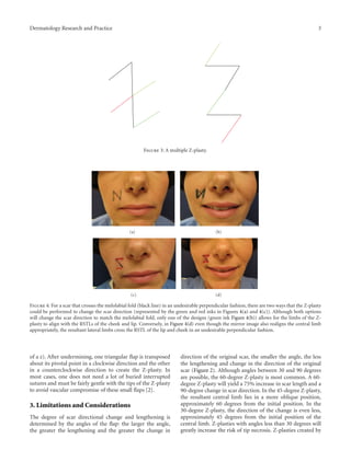 Z plasty made simple | PDF