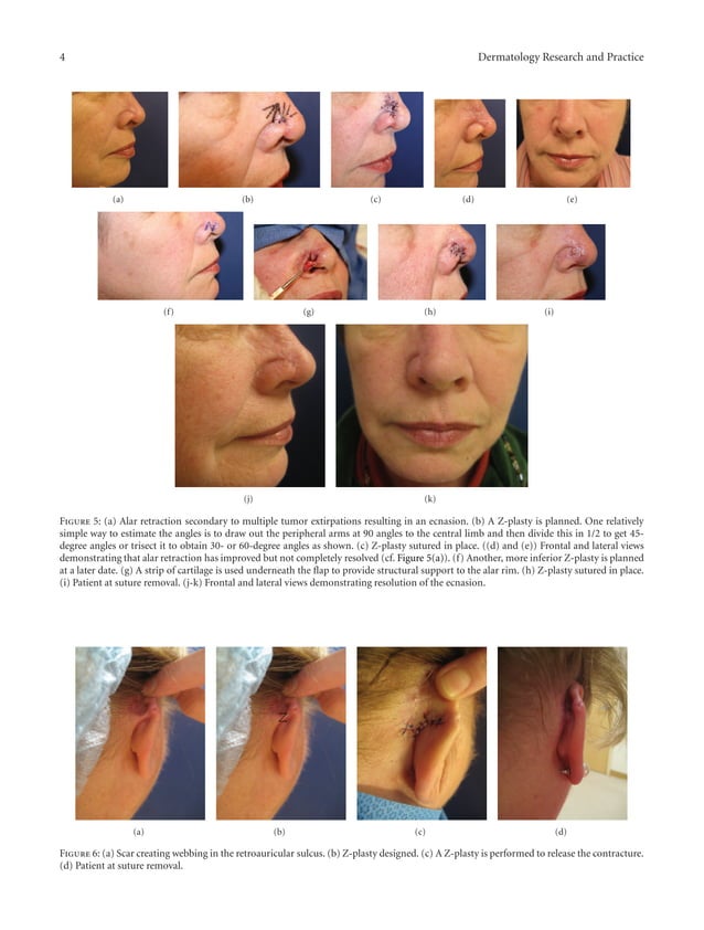 Z plasty made simple | PDF