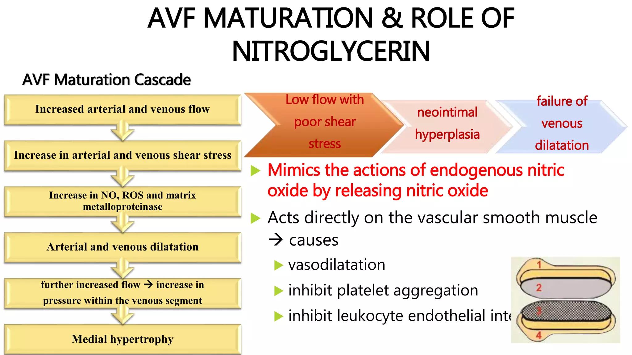 Transdermal Nitroglycerin Role In AVF Maturation | PPT
